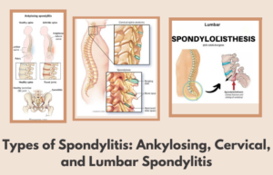 Types of Spondylitis: Ankylosing, Cervical, and Lumbar Spondylitis - dr ...